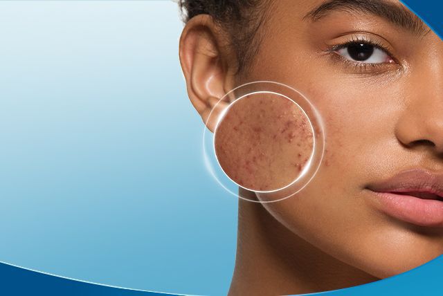 Clear Mattifying Cleanser for Acne Prone Skin | Cetaphil IN